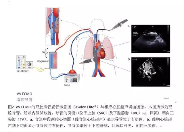 体外膜氧合支持的成人患者的心脏超声（1）-企业官网