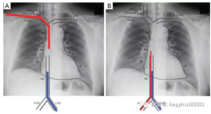 Bedside troubleshooting during venovenous ECMO---V-V ECMO床边故障排除-急重危症救援中心